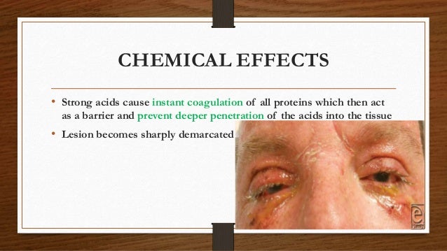 Chemical injuries of the eye