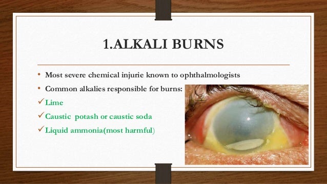 Chemical injuries of the eye