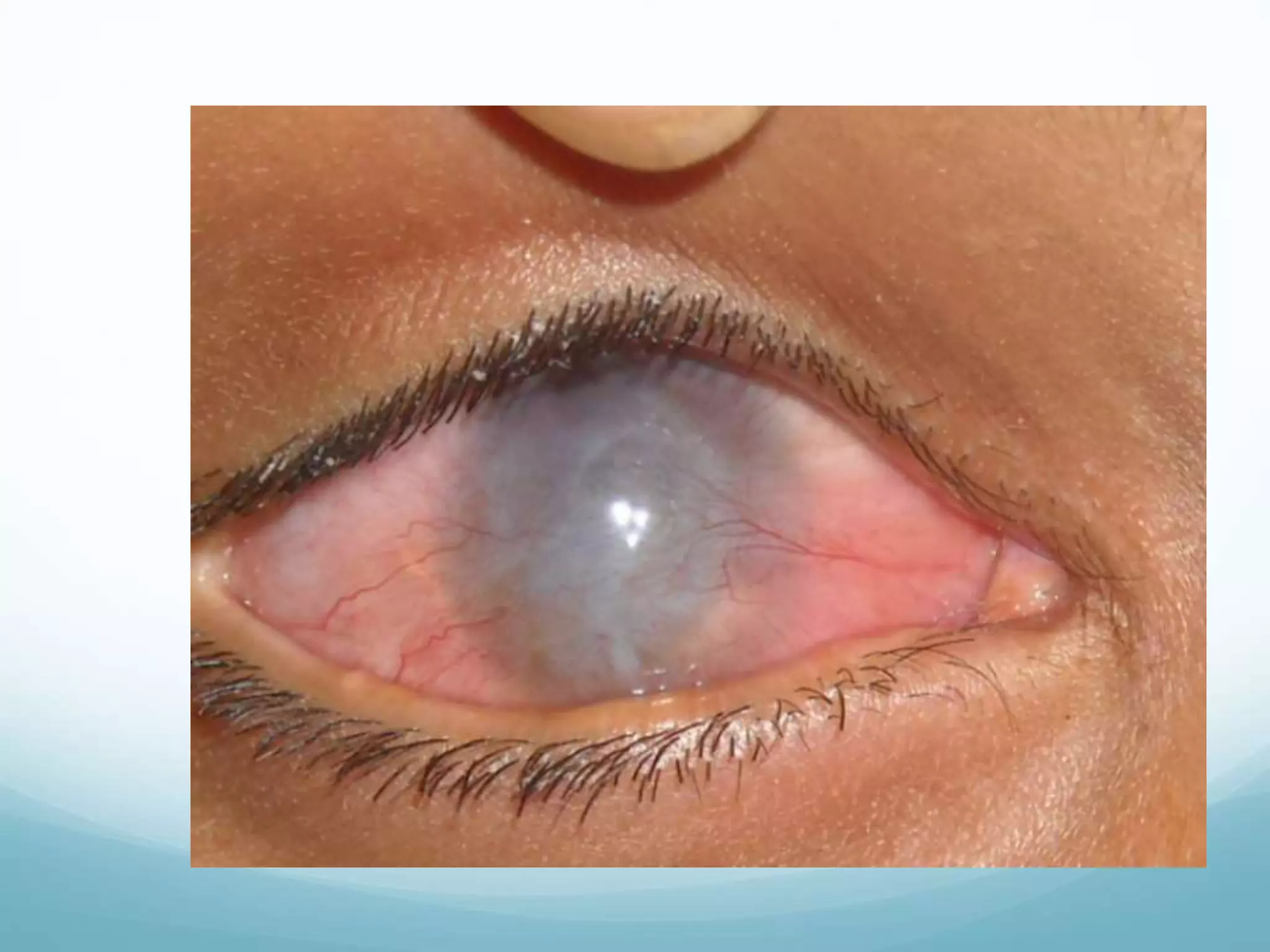 Chemical injuries of the eye | PPTX