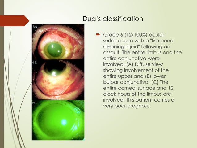 Chemical_Injuries of eye_ppt_Management.pptx