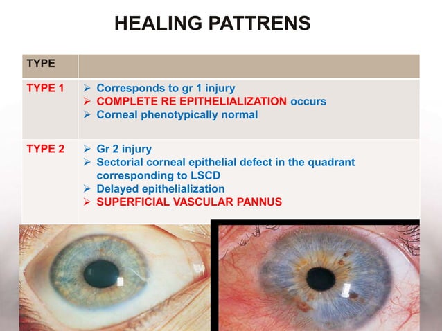 Chemical injuries of the eye | PPTX