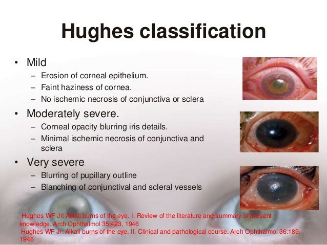 Chemical injuries of the eye