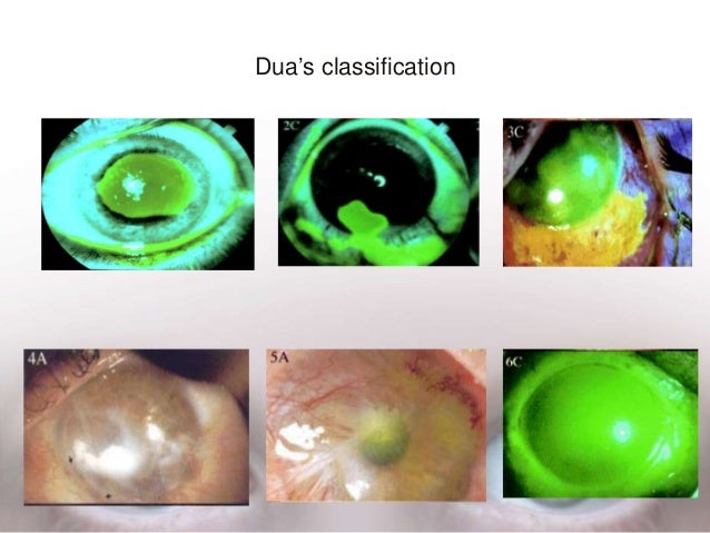Chemical injuries of the eye