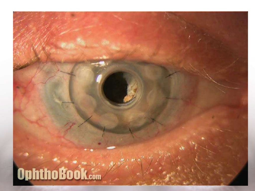 Chemical injuries of the eye