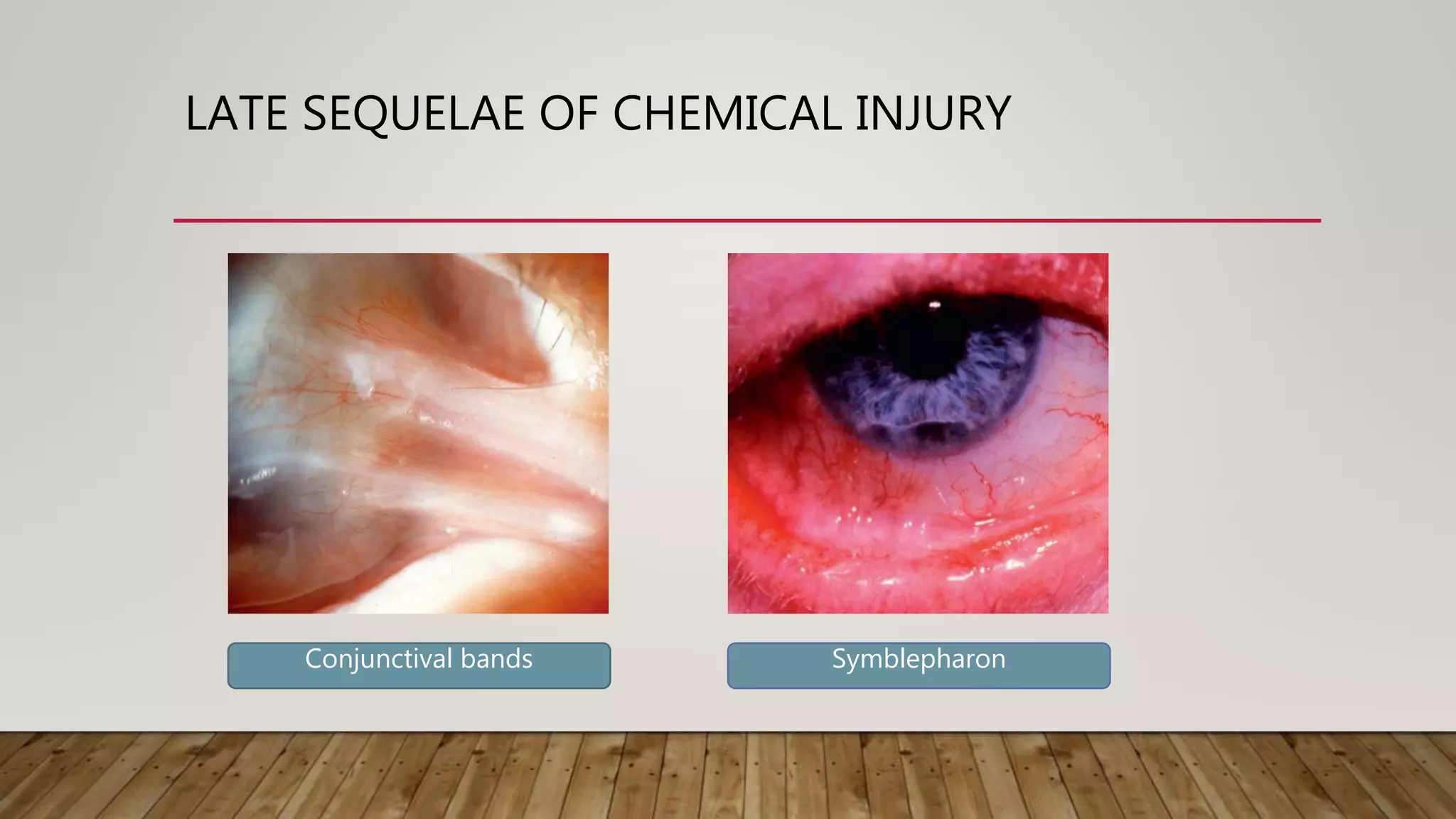 Ocular Chemical Injury | PPTX