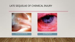 Ocular Chemical Injury | PPTX