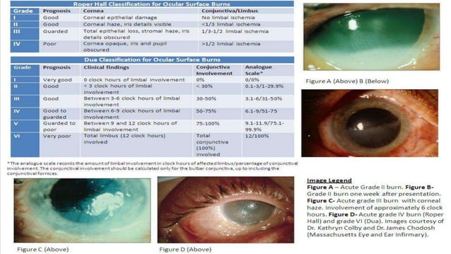 Chemical injury of the eye | PPTX | First Aid | Injuries