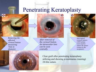 Chemical injury to eye | PPTX