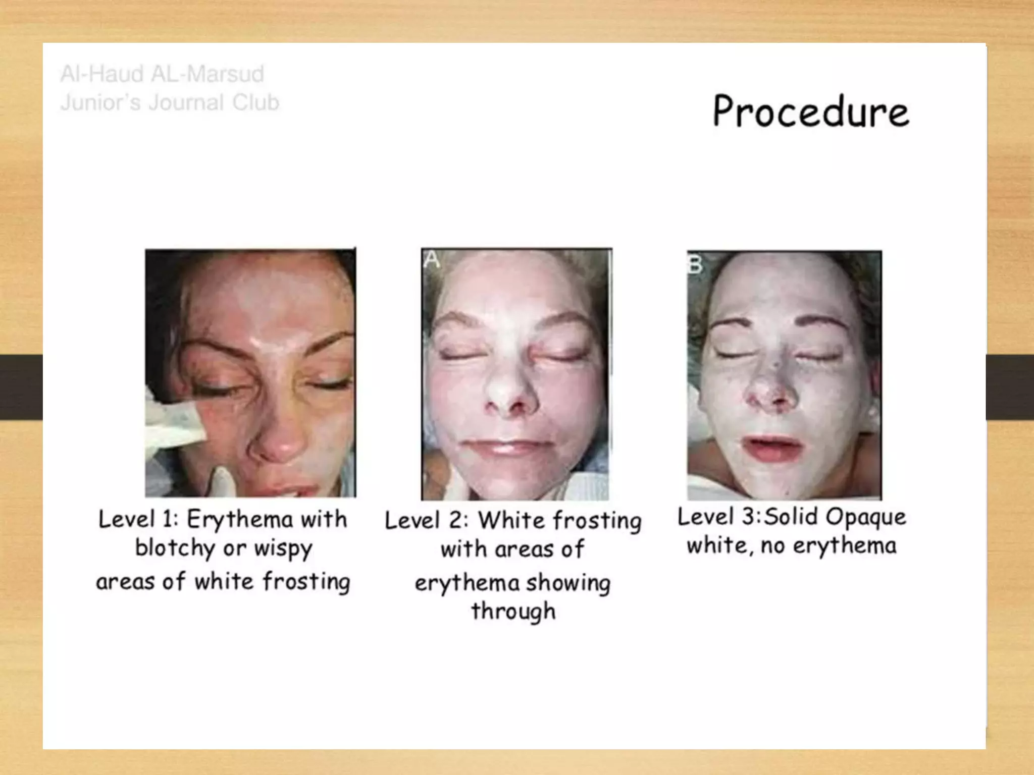 Chemical Peel.pptx