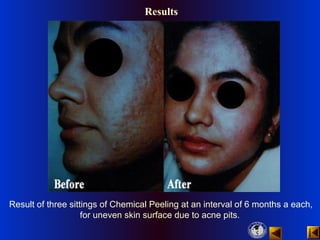 Chemical peeling | PPS