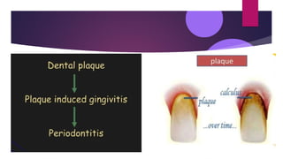 chemical plaque control as a method of plaque control.pptx
