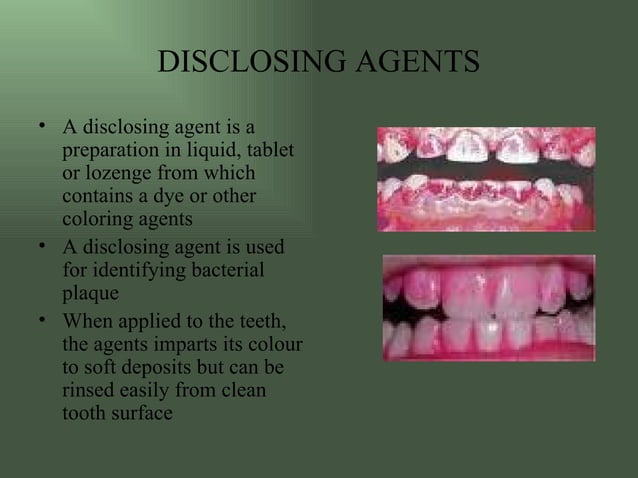 Chemical Plaque Control | PPT | Dental Health | Diseases and Conditions