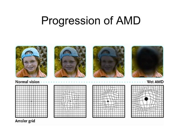 Chemistry Of Vision Final | PPT | Eye and Vision Conditions | Diseases ...