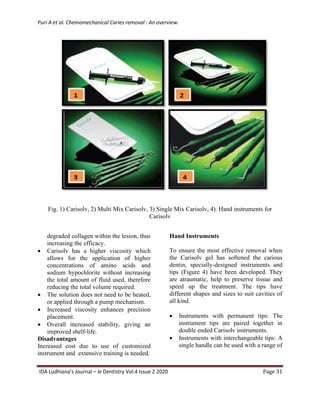 Chemomechanical Caries removal - overview.pdf
