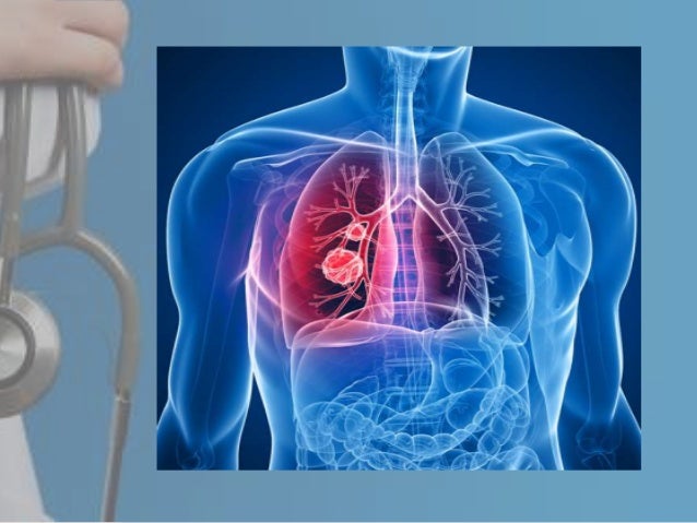 Chemotherapy At Different Stages Of Lung Cancer