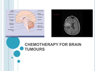 Brain Tumor Chemotherapy