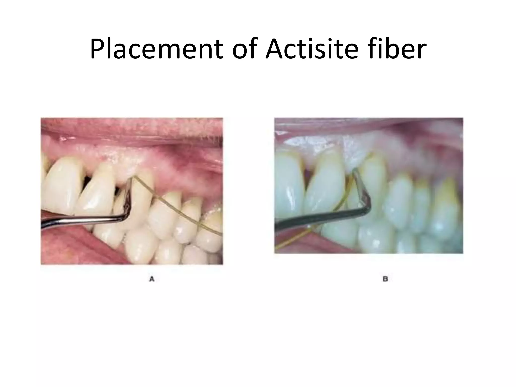 Chemotherapy in periodontology | PDF