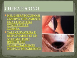 Cheratocono, eziopatogenesi e diagnosi | PPT