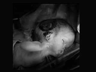 Chernobyl Radiation Victims | PPT