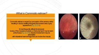 Macular dystrophies introduction to latest diagnostic method | PPT