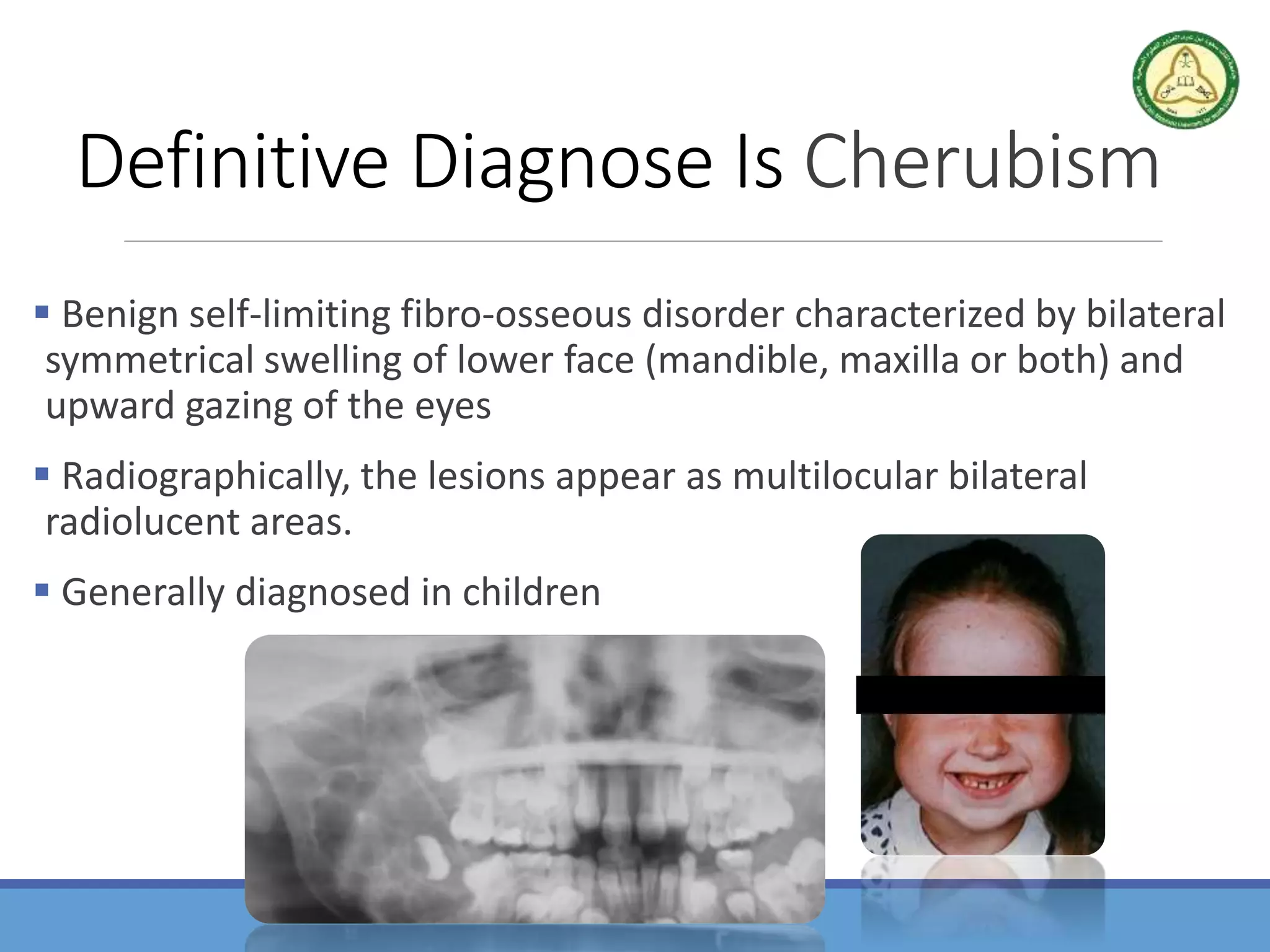 Cherubism "case presentation " | PPTX