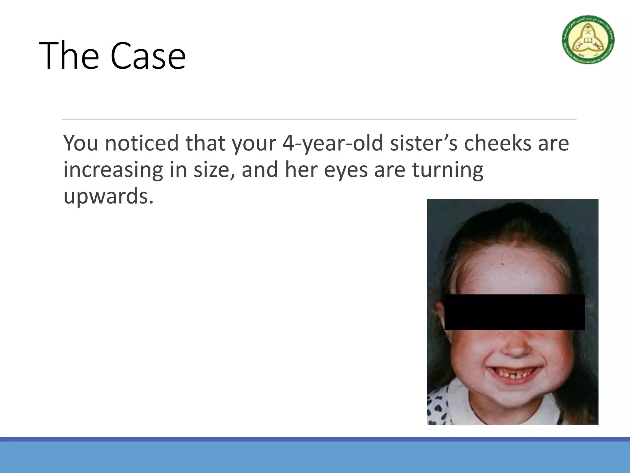 Cherubism "case presentation " | PPTX