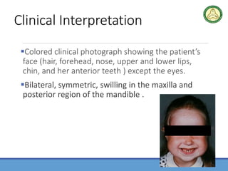 Cherubism "case presentation " | PPTX