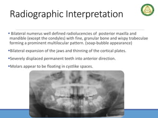 Cherubism "case presentation " | PPTX