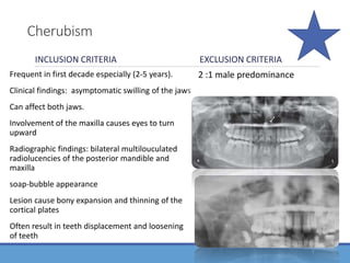 Cherubism "case presentation " | PPTX
