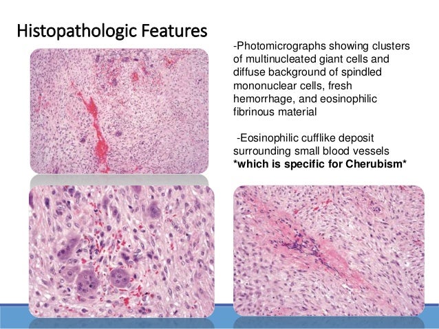 Cherubism "case presentation