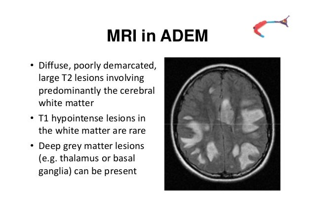 Diagnosis of MS and related disorders in children - Cheryl Hemingway
