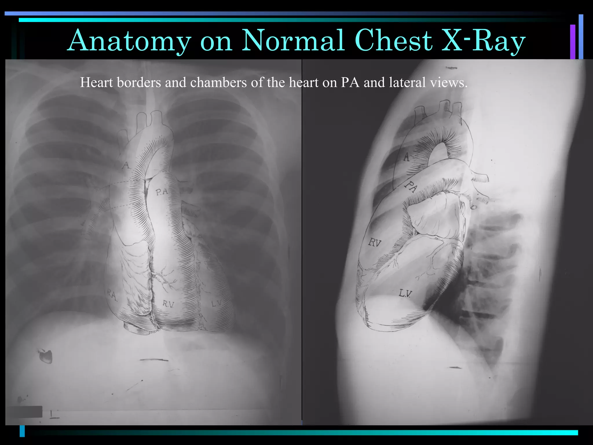 Chest X-ray anatomy | PPS