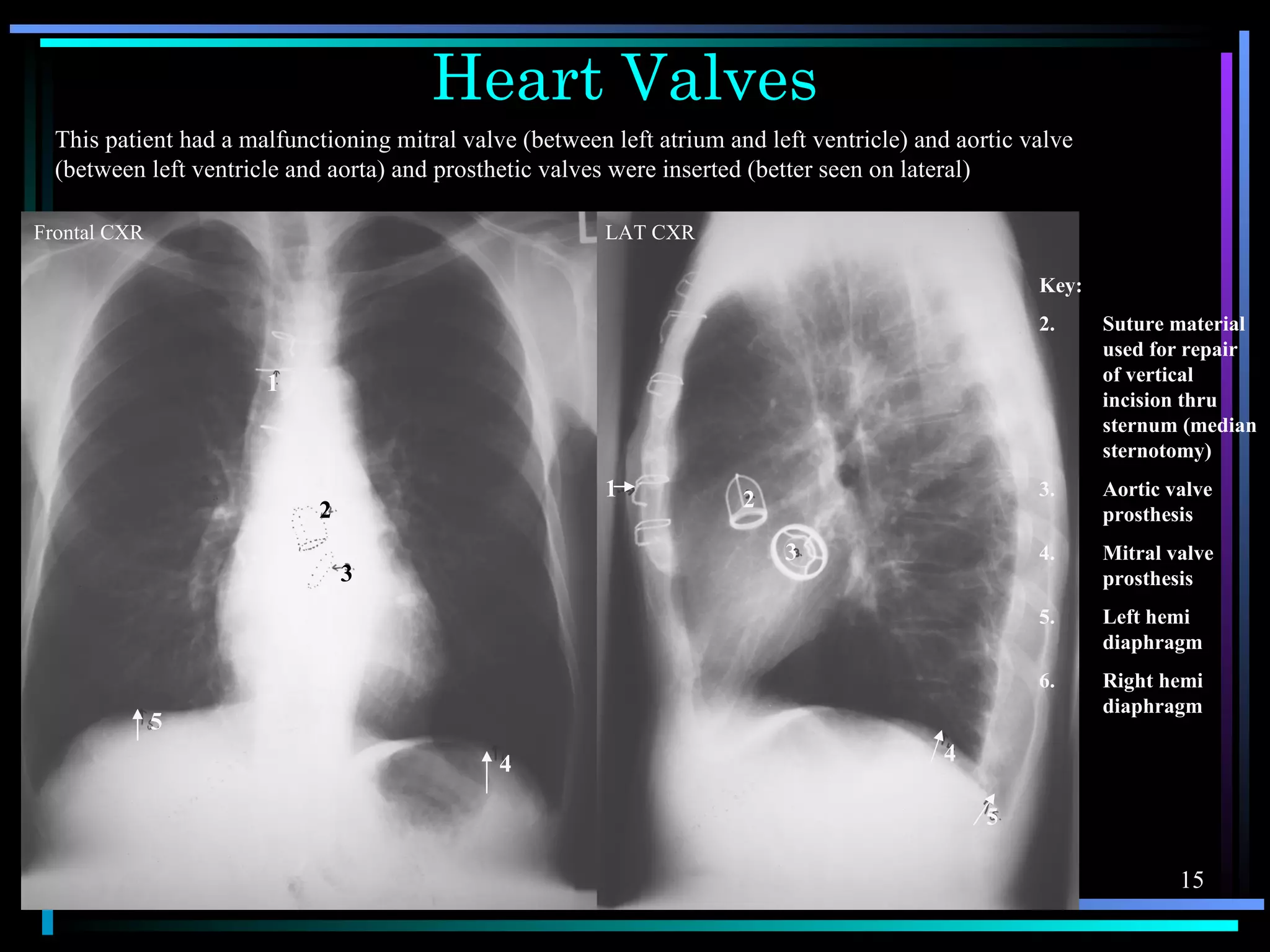 Chest X-ray anatomy | PPS