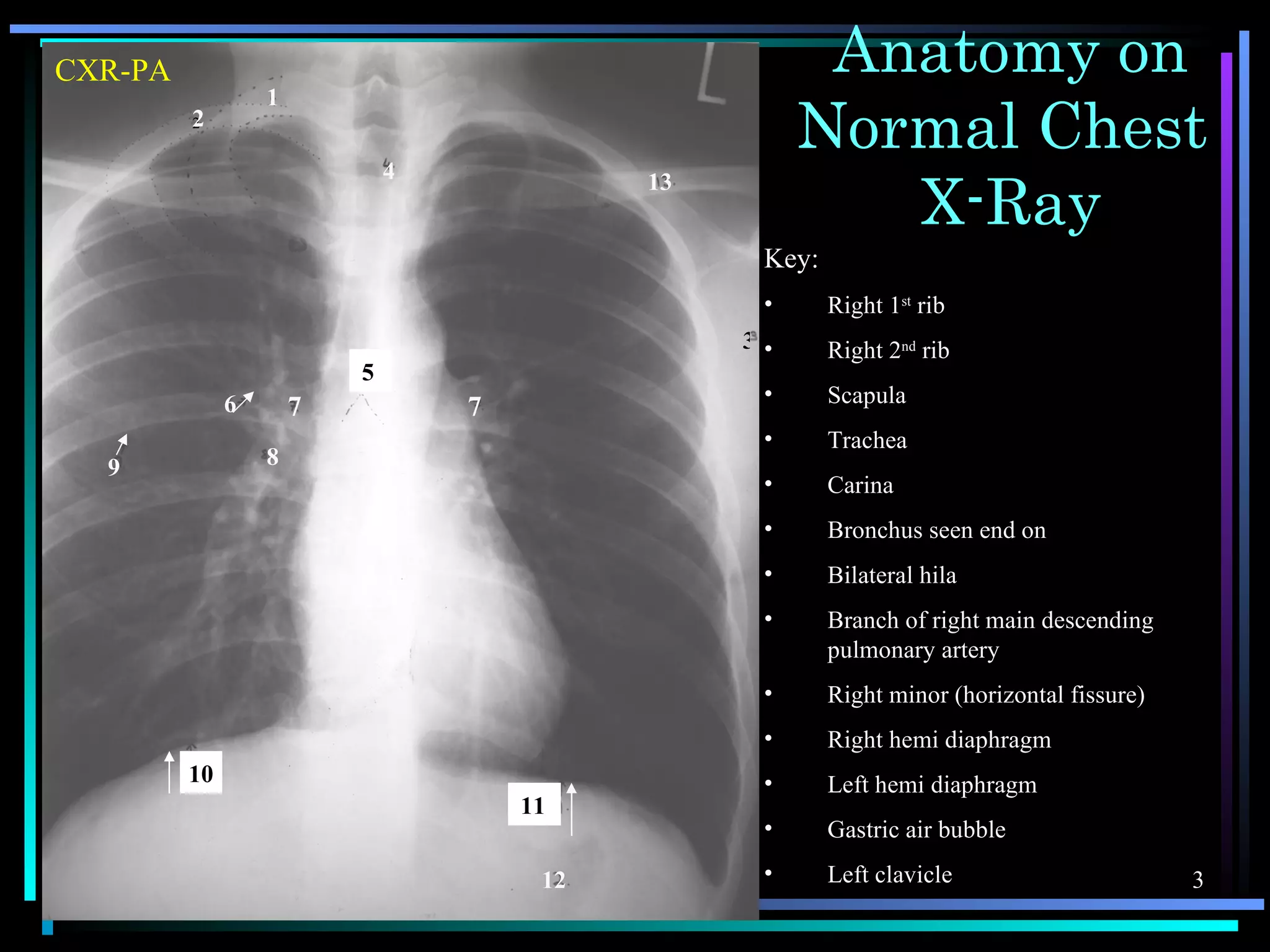 Chest X-ray anatomy | PPS