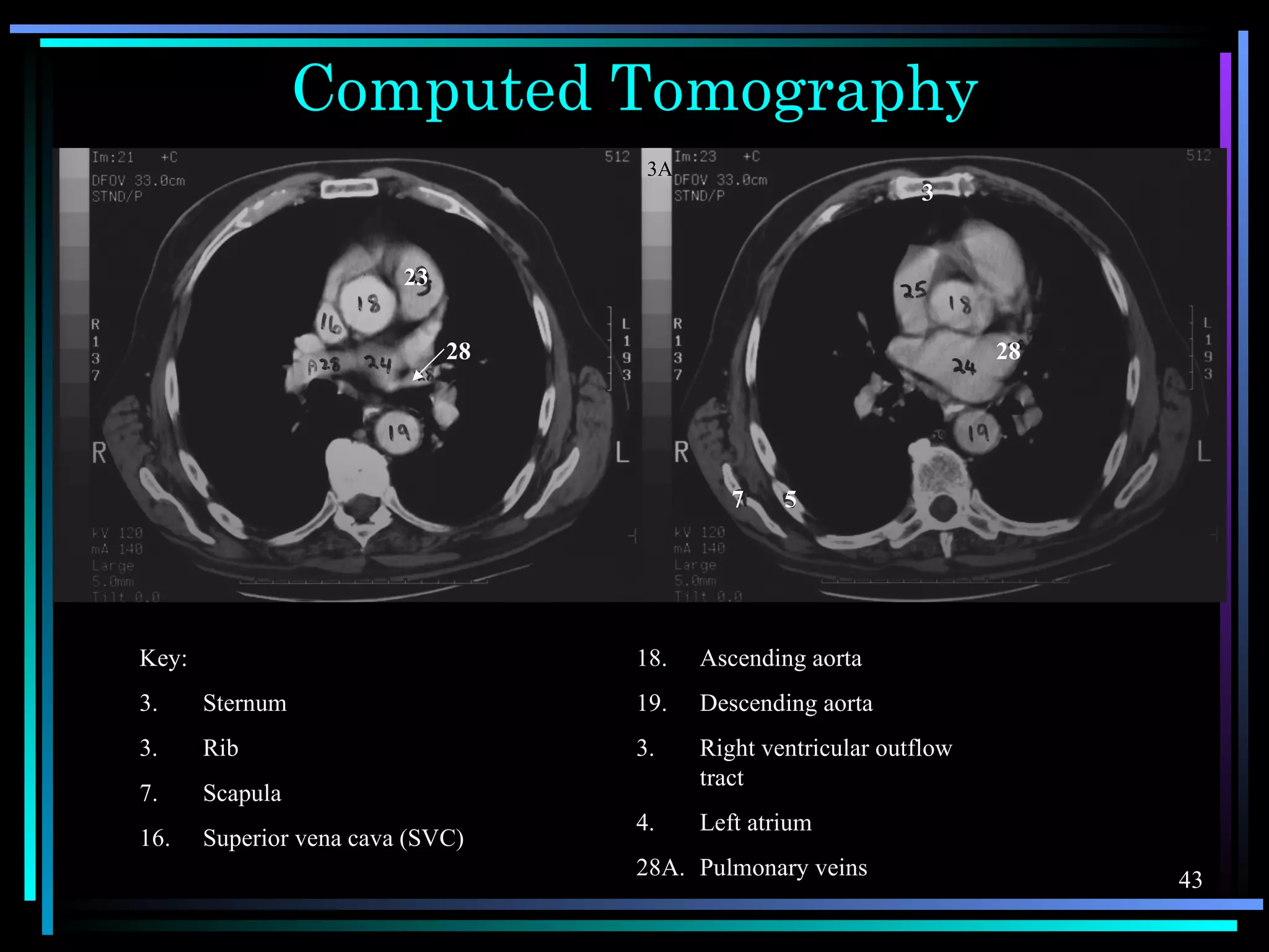 Chest X-ray anatomy | PPS