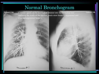 Chest X-ray anatomy | PPS