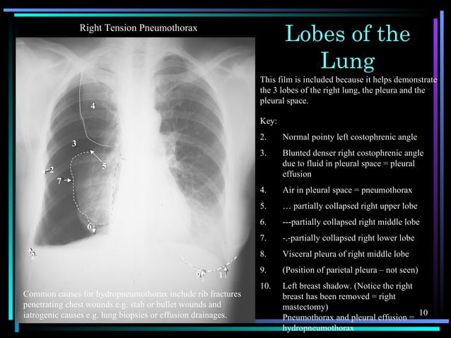 Chest X-ray anatomy