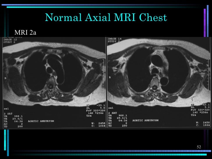 Chest X-ray anatomy