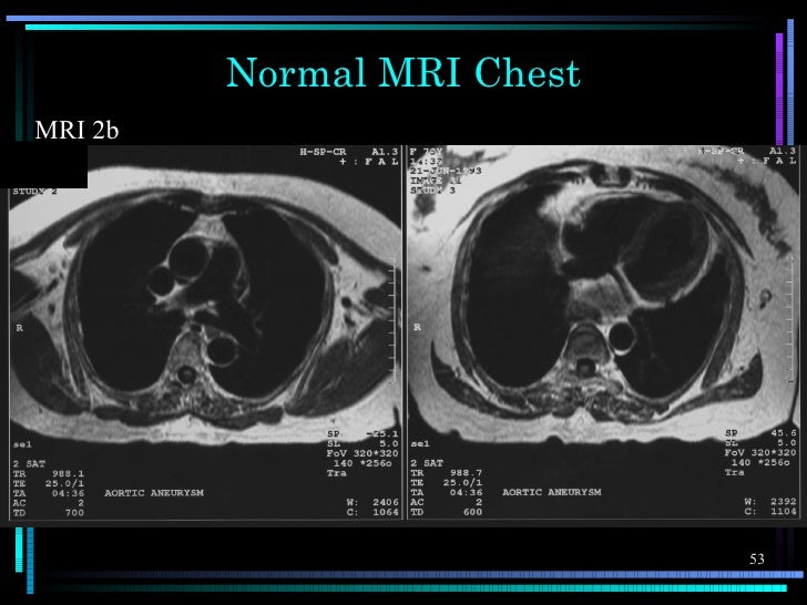 Chest X-ray anatomy