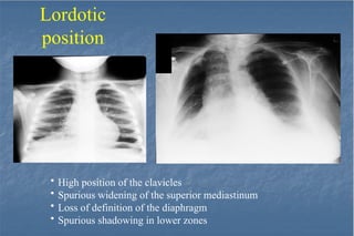 chest principles of radioanatomy mmed.pptx