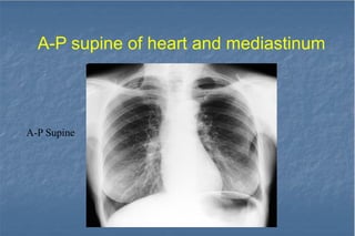 chest principles of radioanatomy mmed.pptx