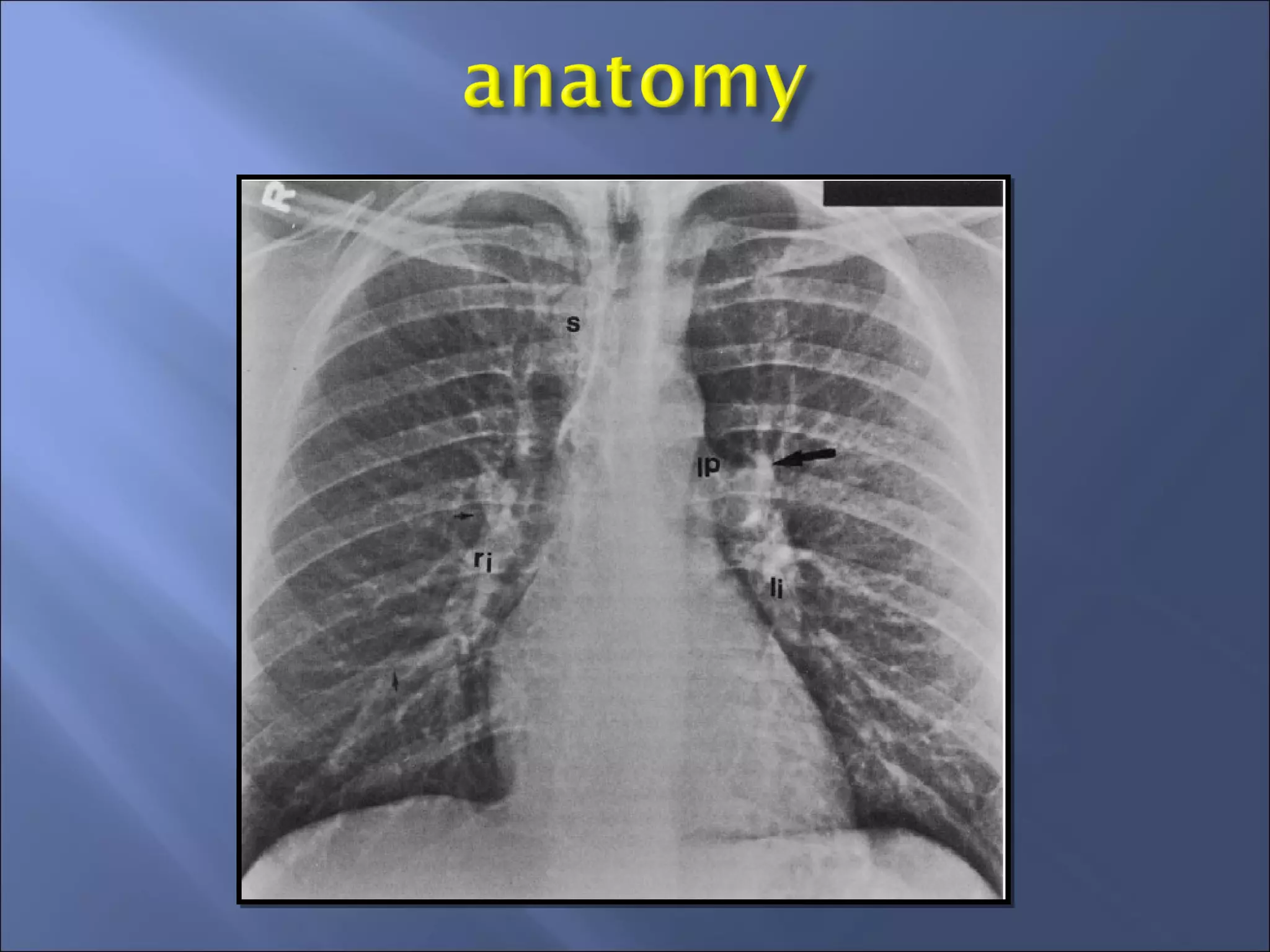 Chest Imaging for Medical Students | PPT | Lung and Respiratory Health ...