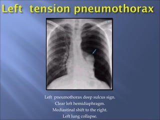 Chest Imaging for Medical Students | PPT