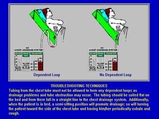 Chest Drainage | PPT