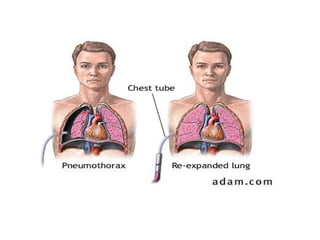 Chest Drainage | PPT
