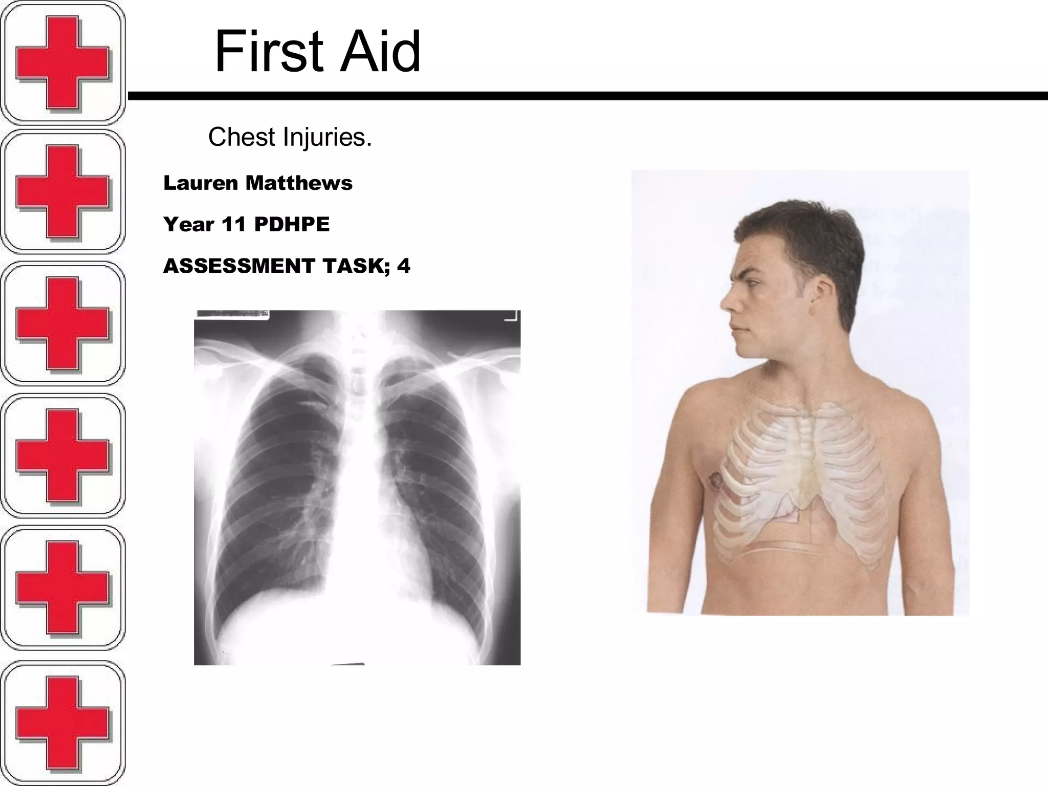 Chest Injuries | PPT
