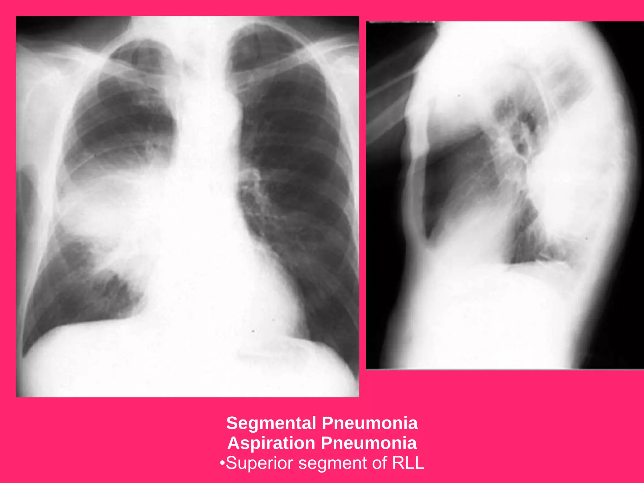 Chest xrays pneumonias | PPT