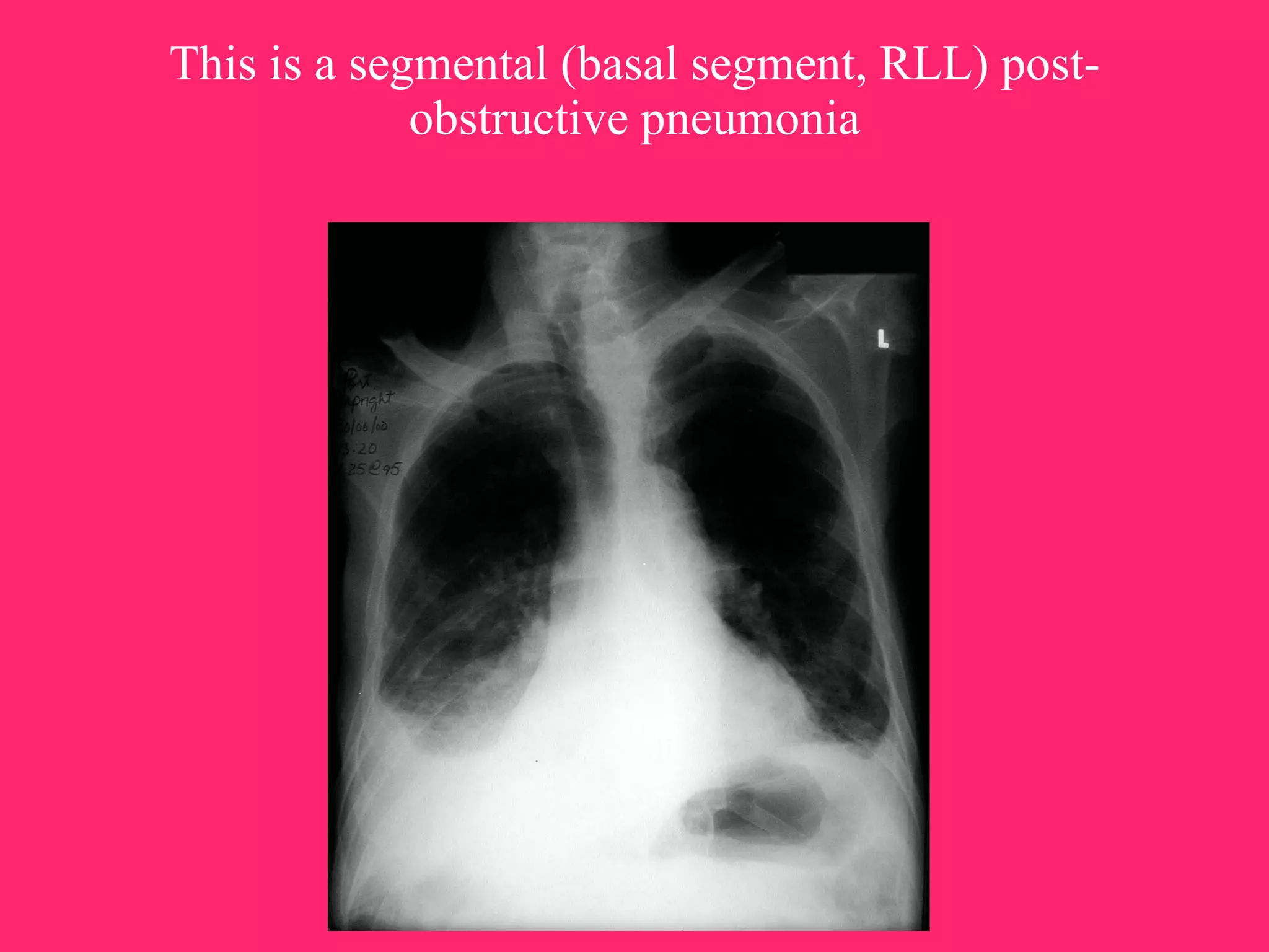 Chest xrays pneumonias | PPT