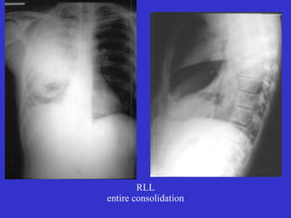 Chest xrays pneumonias | PPT