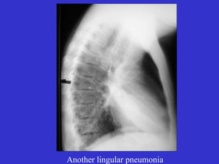 Lingular Pneumonia